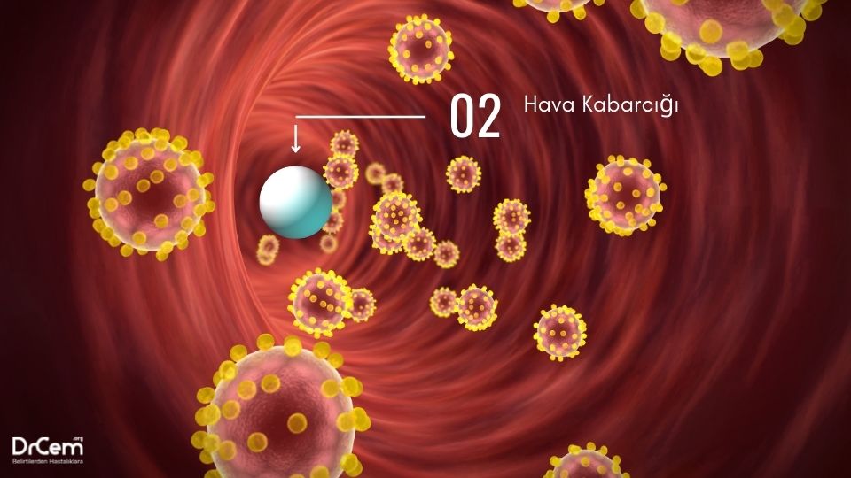 Hava Embolisi Nedir ? - DRCem